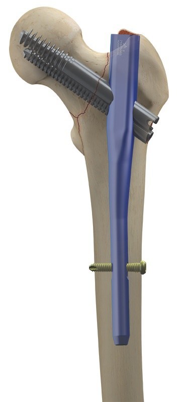 Smith+Nephew introduces ground-breaking assurance program for TRIGEN ...