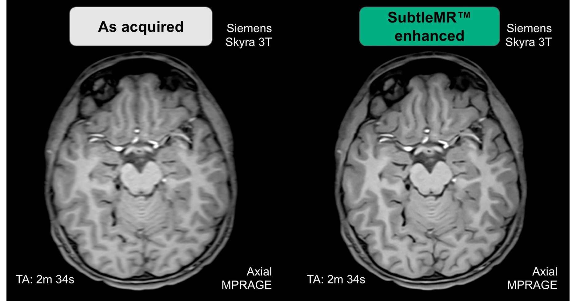 Subtle Medical Receives FDA 510(k) Clearance for AI-Powered SubtleMR™