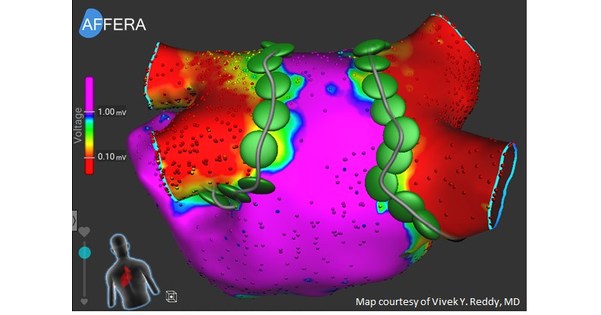 Affera Announces World's First Successful Focal Pulsed Field Ablation ...