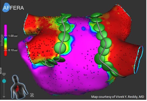 Affera Announces World's First Successful Focal Pulsed Field Ablation ...