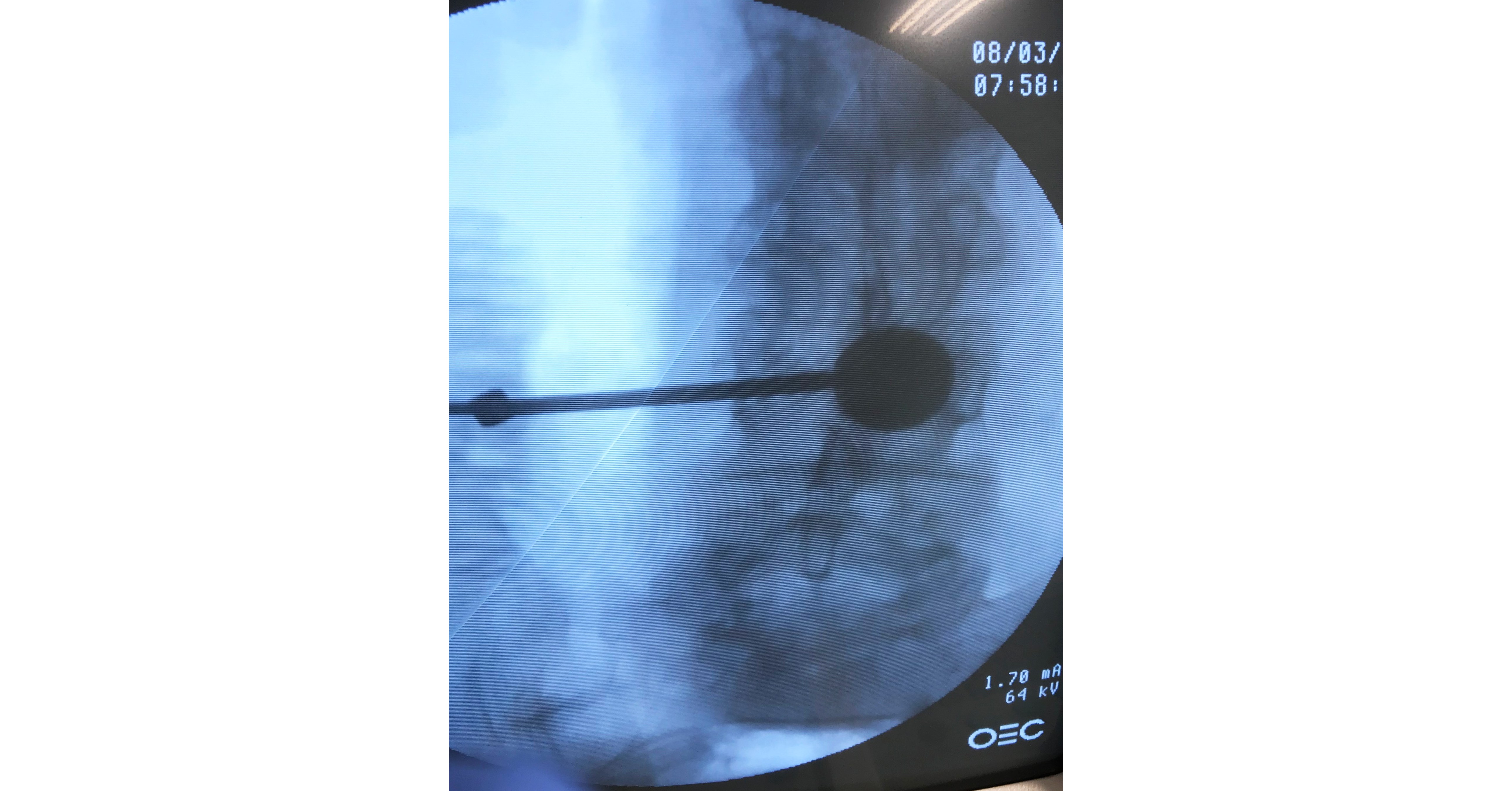 Zavation Facilitates 10,000+ Kyphoplasty Procedures in 2019 With Novel ...