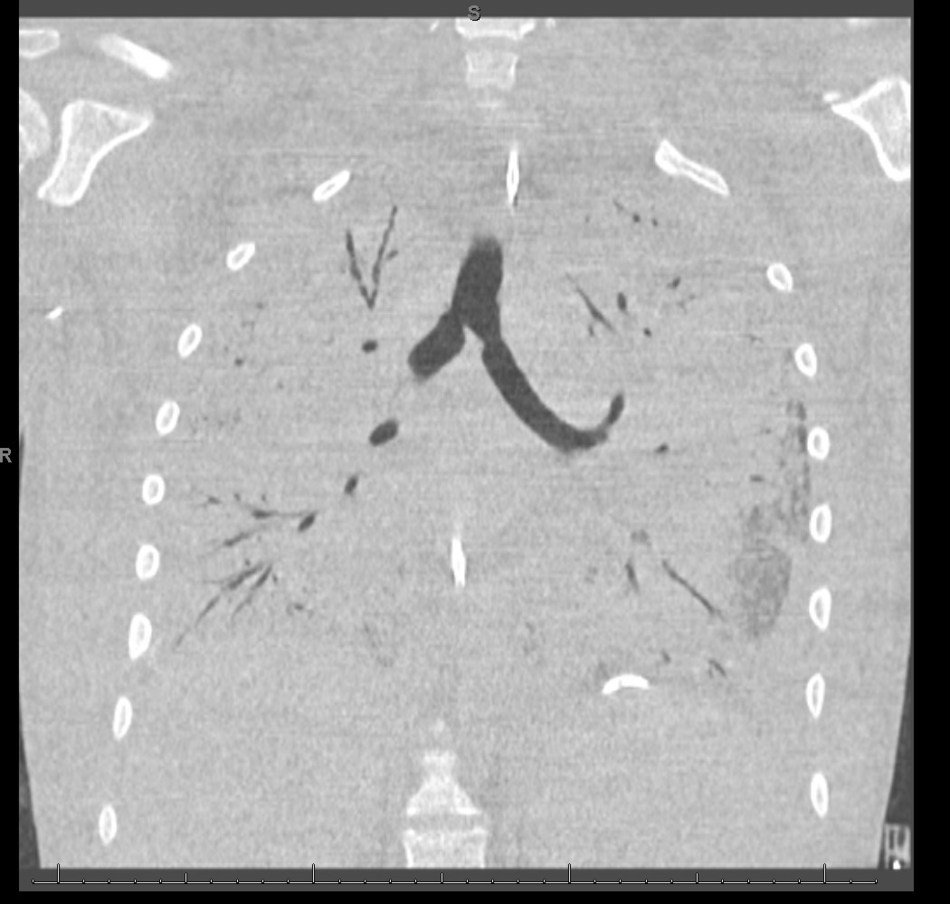 First Double Lung Transplant Patient Injured by Vaping Shares Story to ...