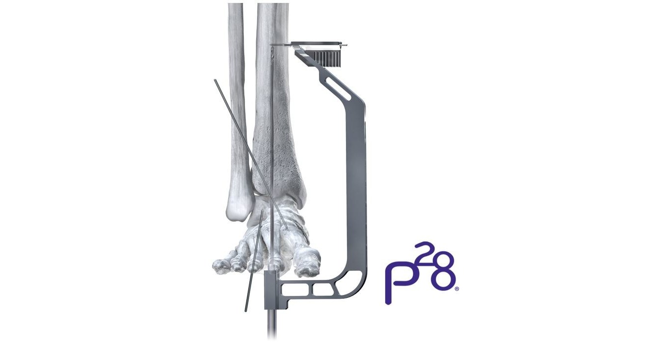 Paragon 28® Phantom® ActivCore Nail System Receives 510(k) Clearance ...