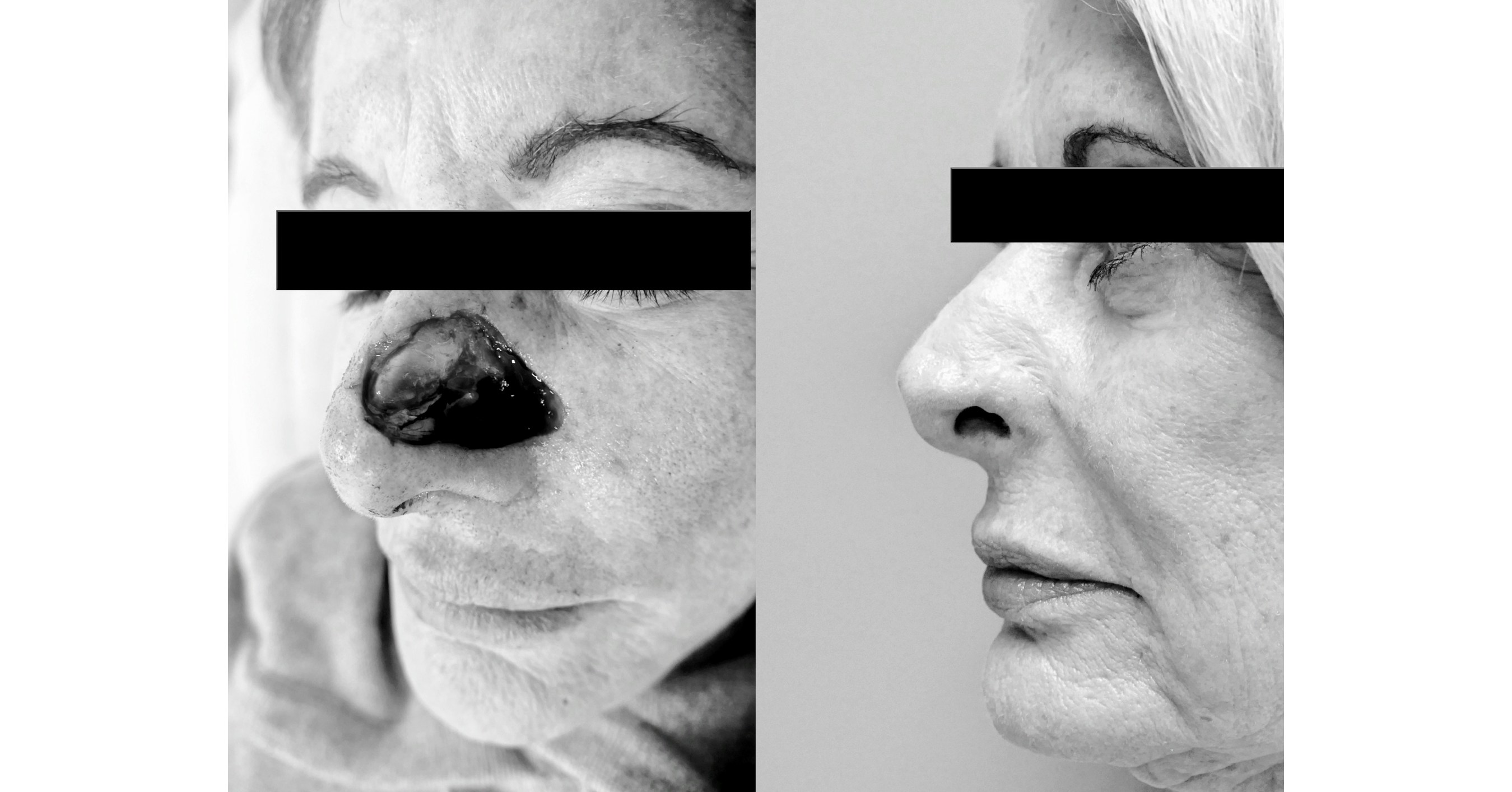 New Techniques for Treating Advanced Skin Cancer After Mohs Chemosurgery