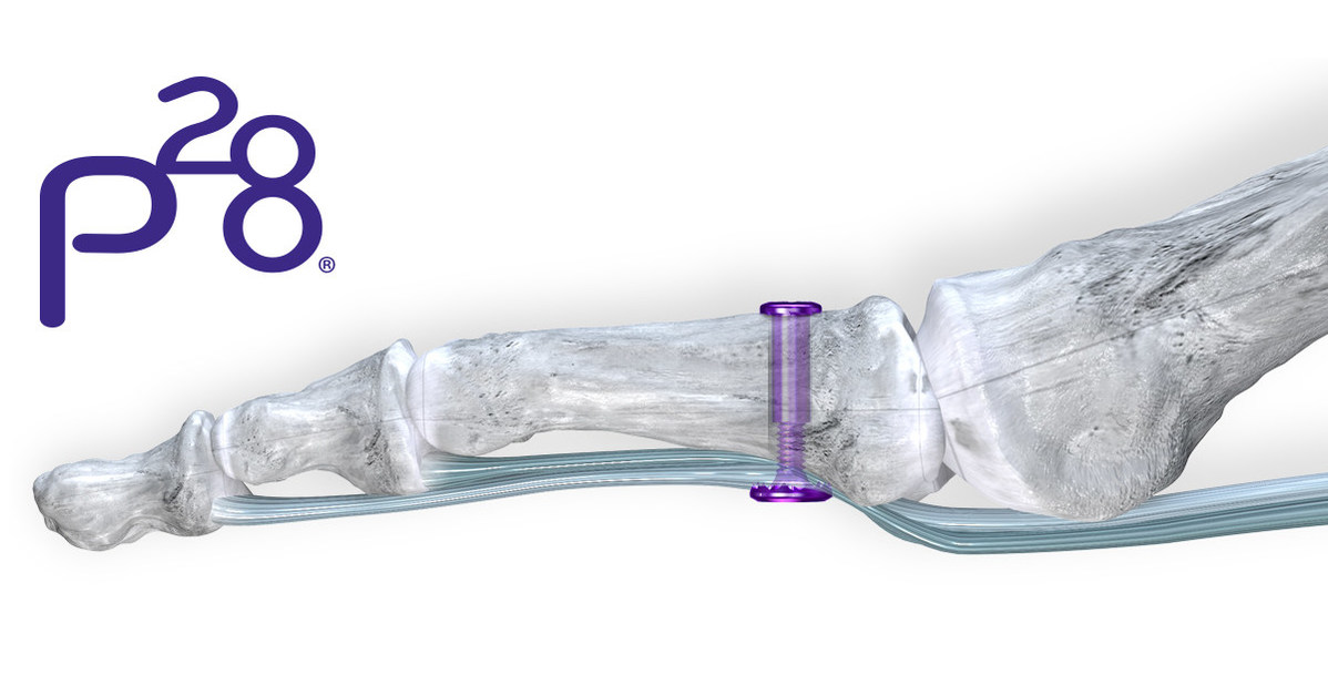 Paragon 28® Adds Larger Implant Option to Help Address Hallux Malleus ...