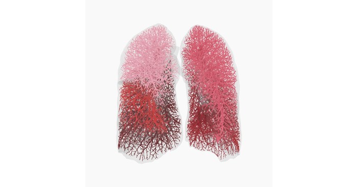 FDA Clears Fluidda's Broncholab Platform for Use in Clinical Practice