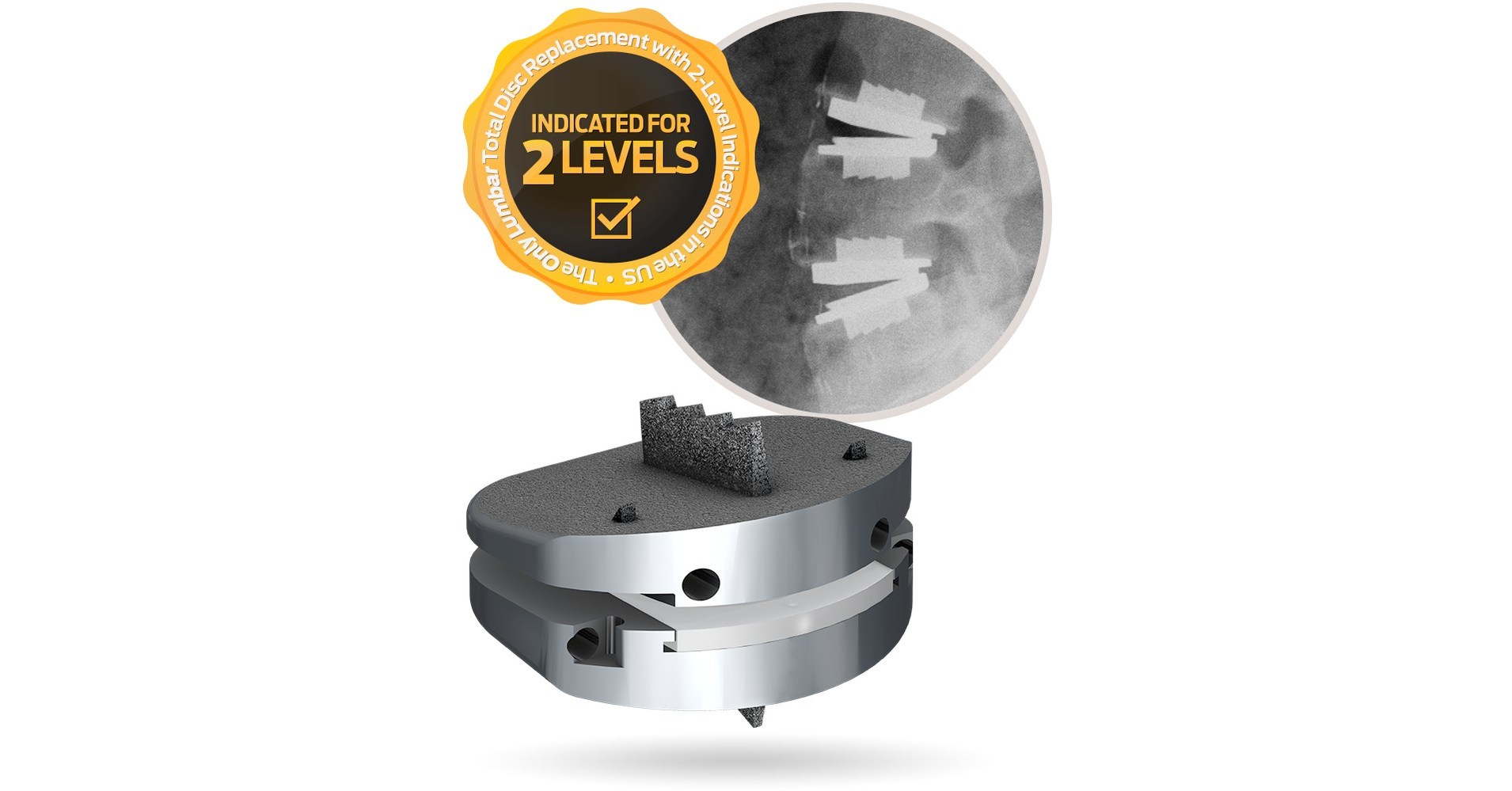 Centinel Spine Announces FDA Approval for Two-level prodisc® L Total ...