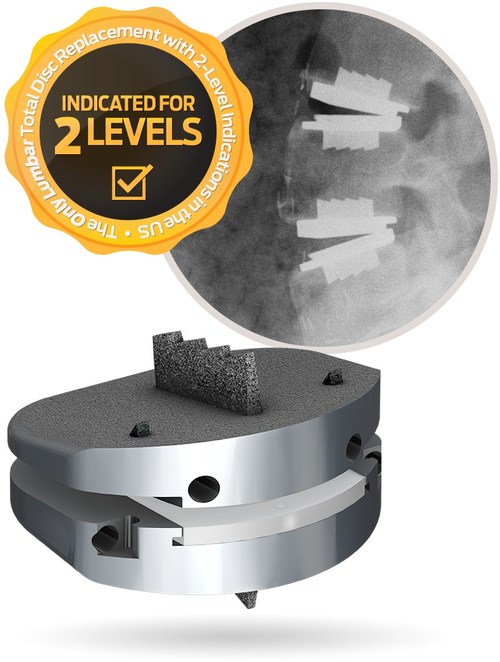 Centinel Spine Announces FDA Approval for Two-level prodisc® L Total ...