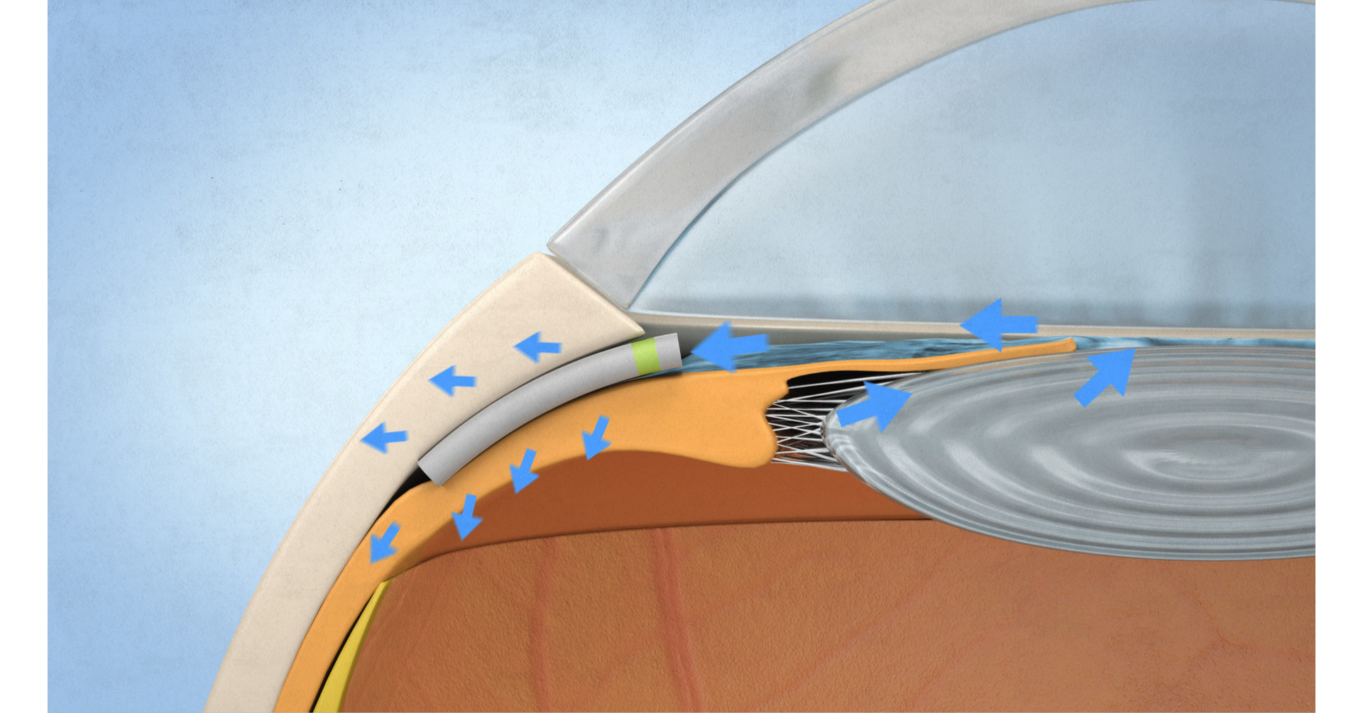 First truly biocompatible MIGS implant from iSTAR Medical shows ...