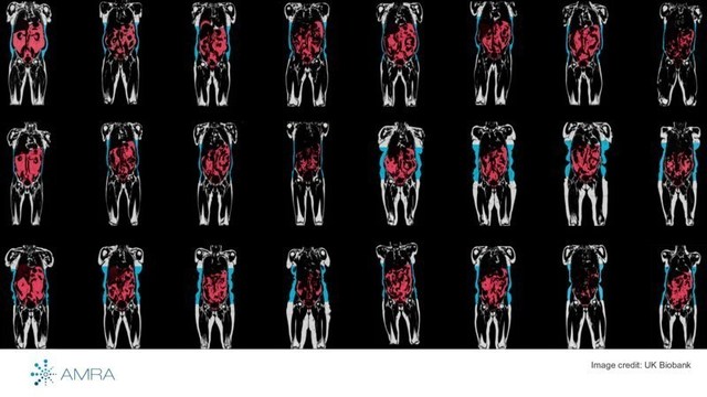 AMRA Medical renews collaboration with Pfizer Inc. aiming to generate ...