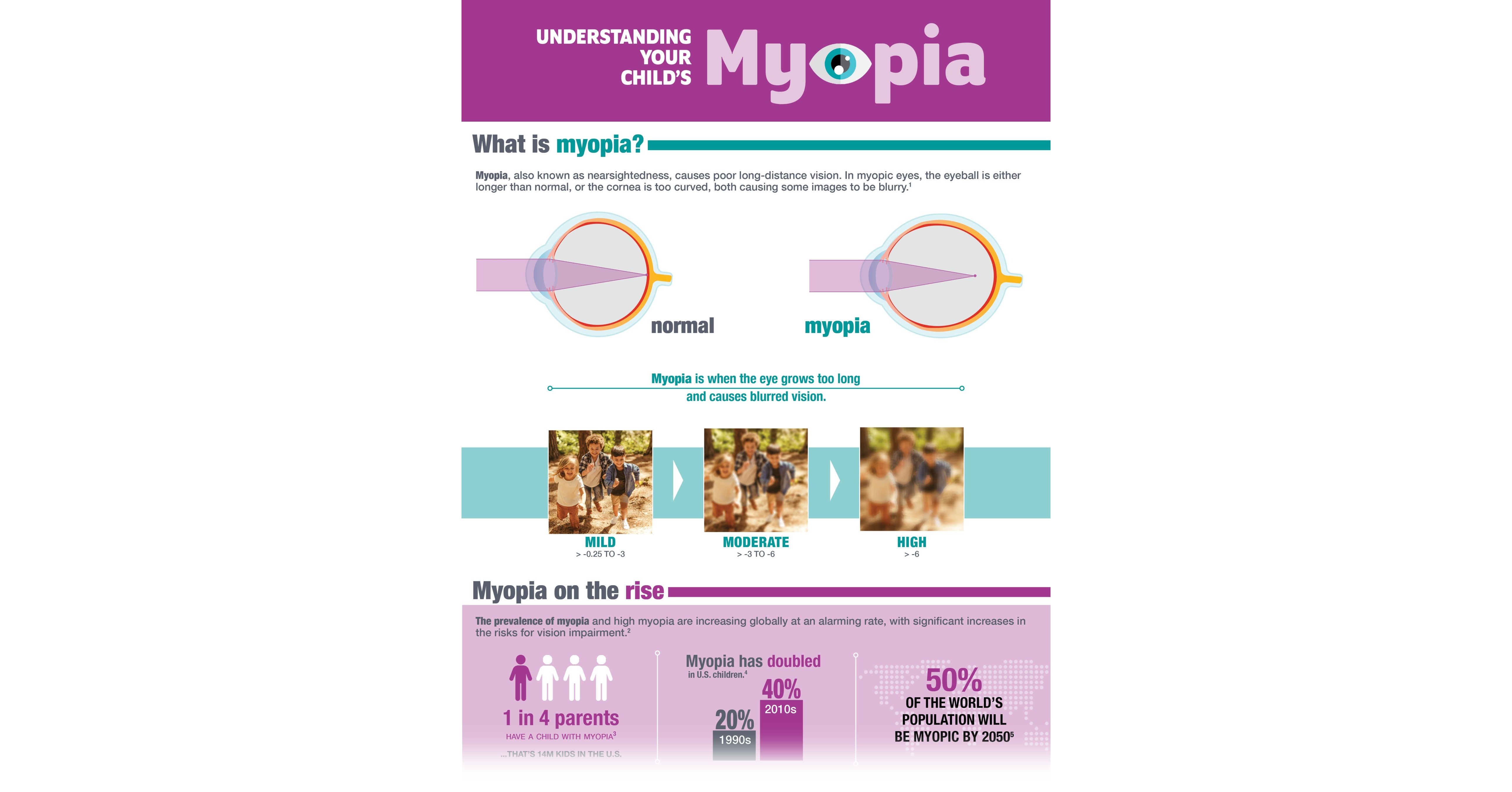 MyMyopia™ Introduces Infographic for Easy Understanding of Myopia, its ...