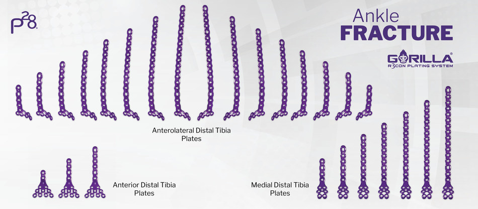 Paragon 28® Increases its Robust Ankle Fracture Offering - Gorilla ...