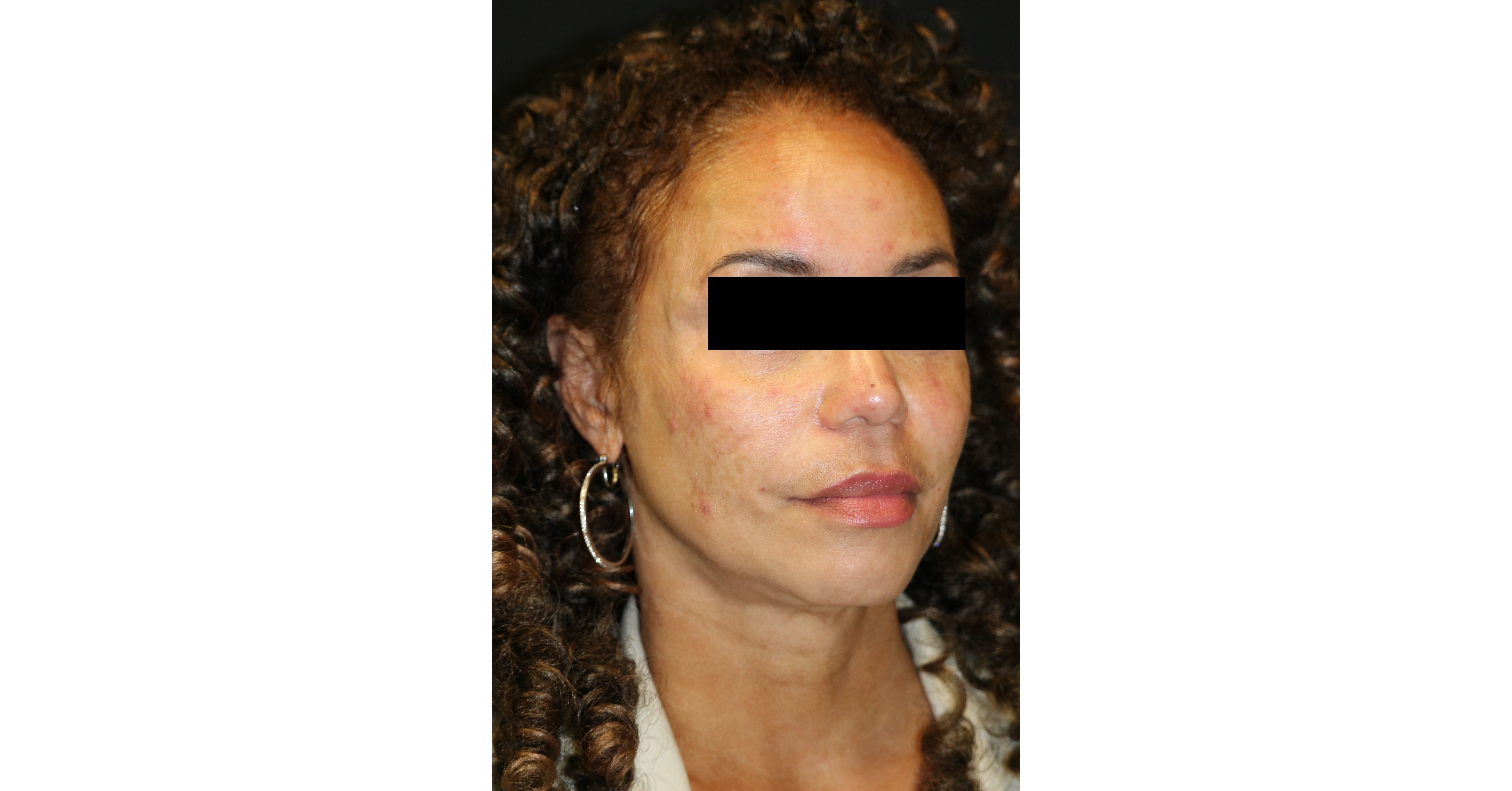 Acne Study Published in the International Journal of Pharmaceutica ...