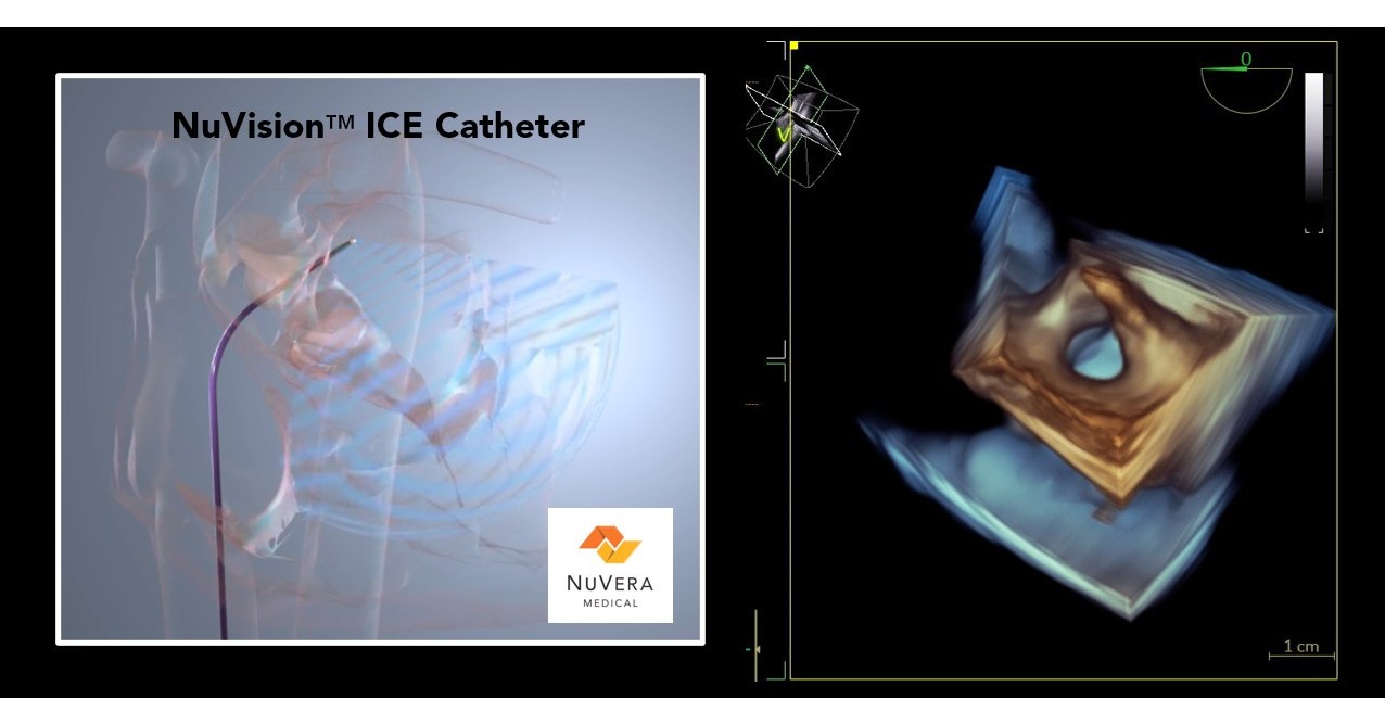 NuVera Announces Successful First-in-Human Use of NuVision™ ICE Catheter