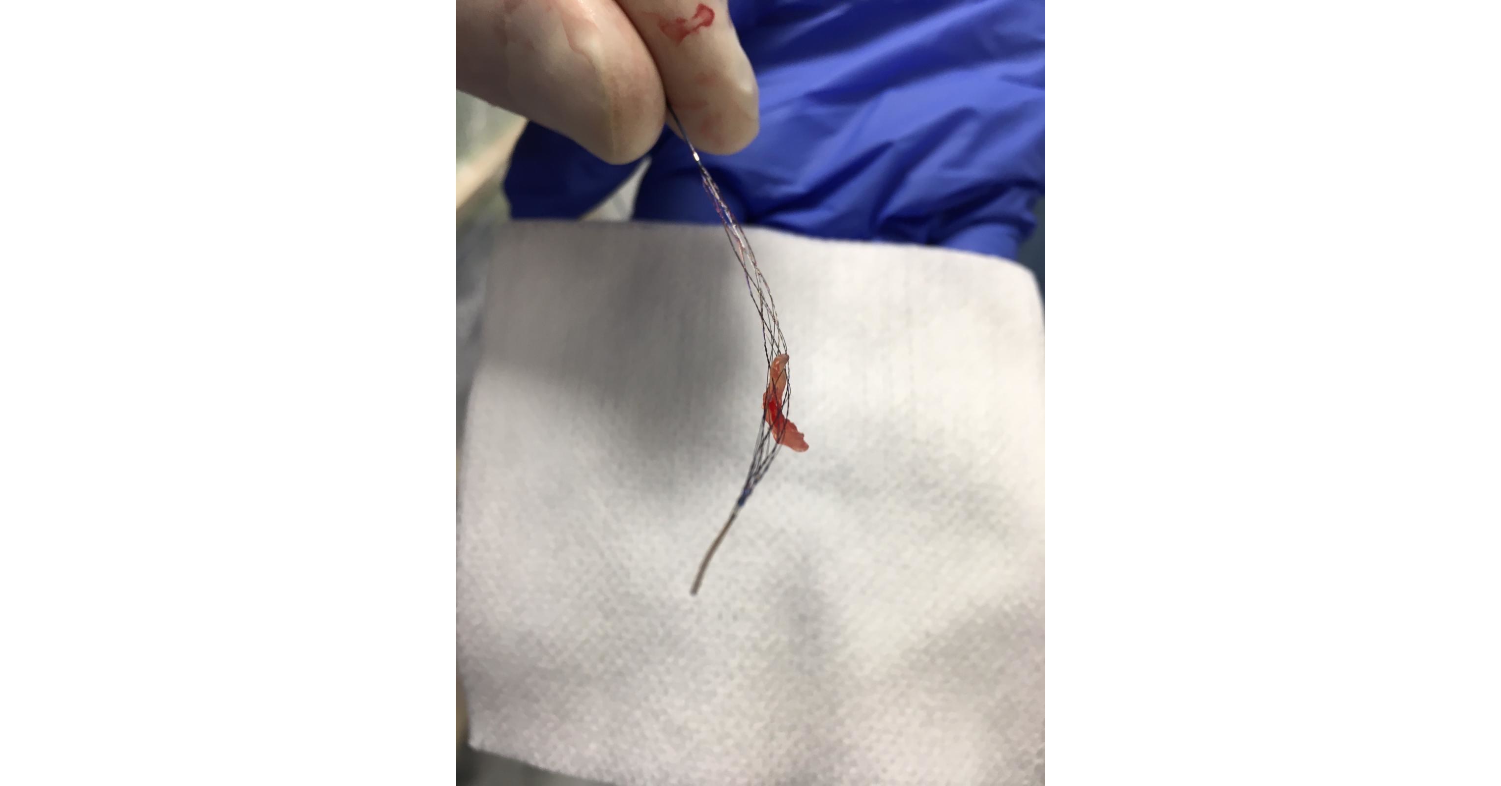 Rapid Medical Receives CE Mark for TIGERTRIEVER™ XL