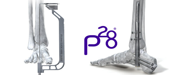 Paragon® 28 Launches Phantom® ActivCore Hindfoot Nail System which ...