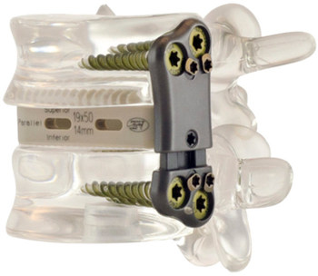 Zavation Medical Products, LLC. Launches Z-Span Expandable Anterior And ...