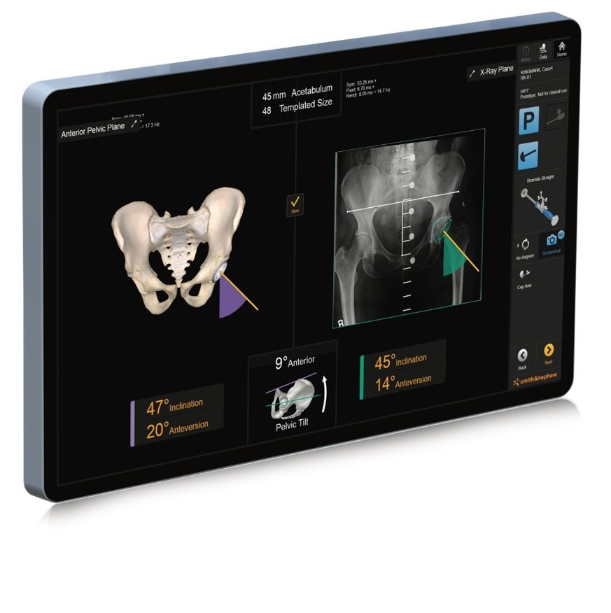 Smith+Nephew announces new RI.HIP NAVIGATION for Total Hip Arthroplasty