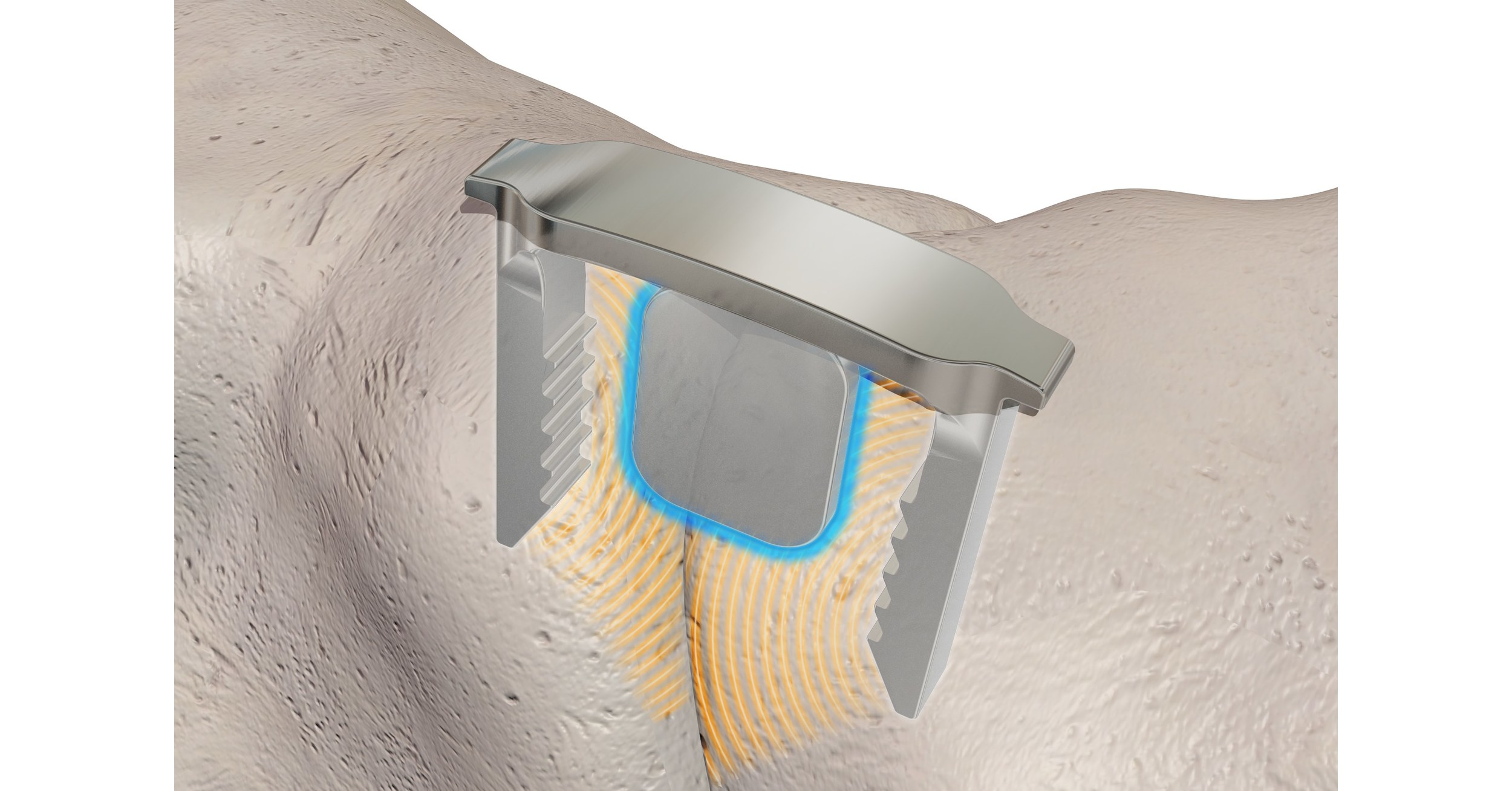 CrossRoads® Extremity Systems, LLC Announces Launch Of The Keel-Lock ...