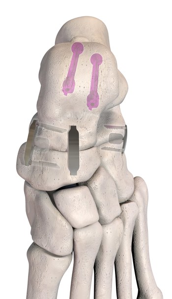 CrossRoads® Extremity Systems, LLC Announces Launch Of The Keel-Lock ...