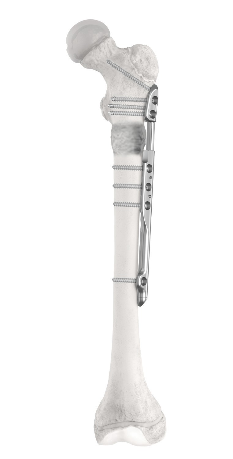 NuVasive Expands Precice Portfolio with First-of-its-Kind Plate for ...