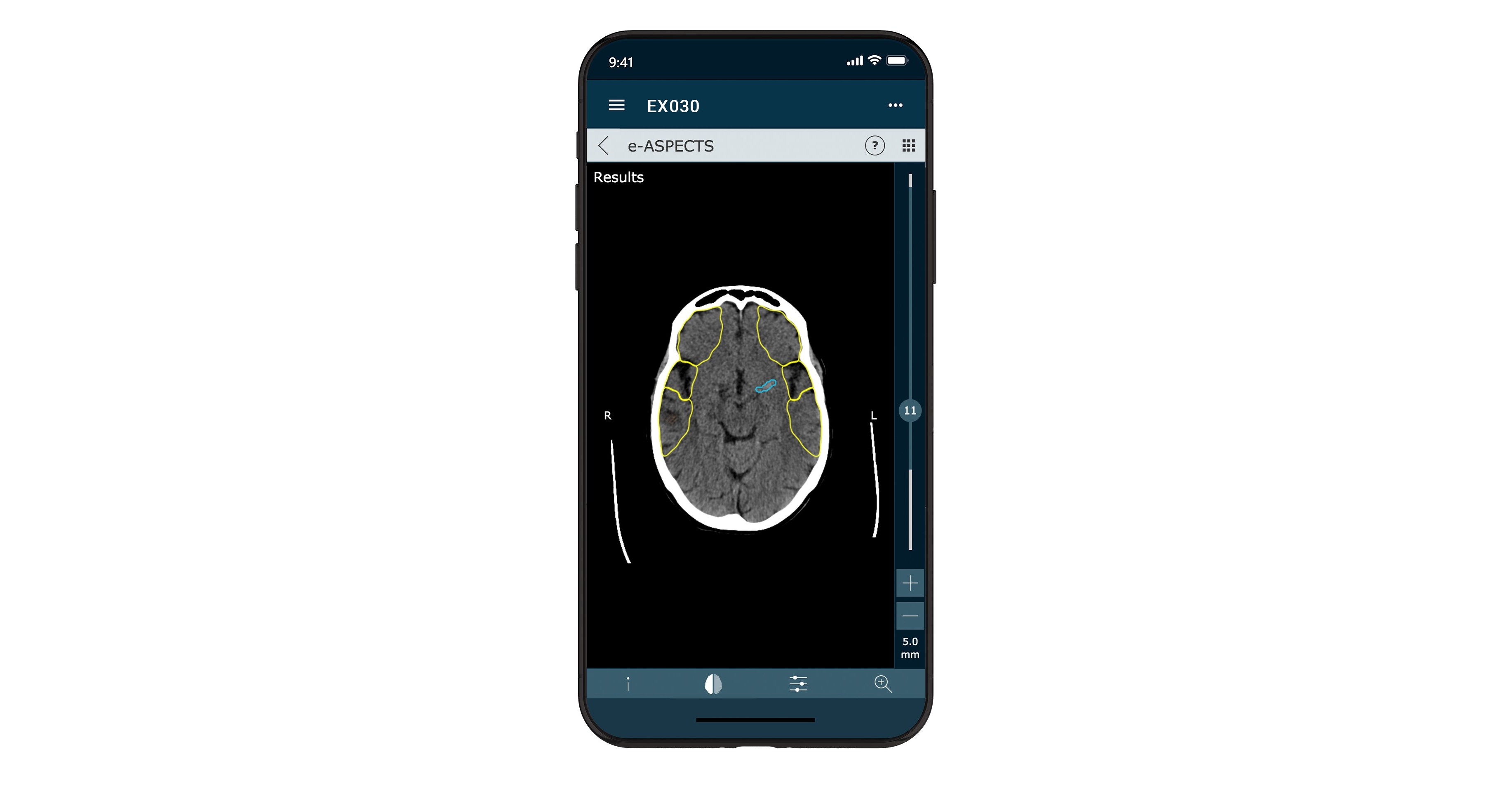 Brainomix Achieves Breakthrough in Stroke Imaging with New Software Release