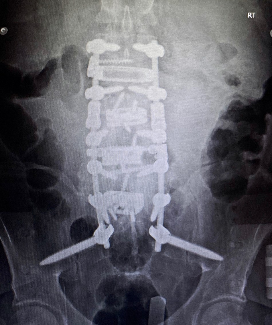 Virginia Spine Surgeon Performs 1st Augmented Reality Spinal Surgery In ...