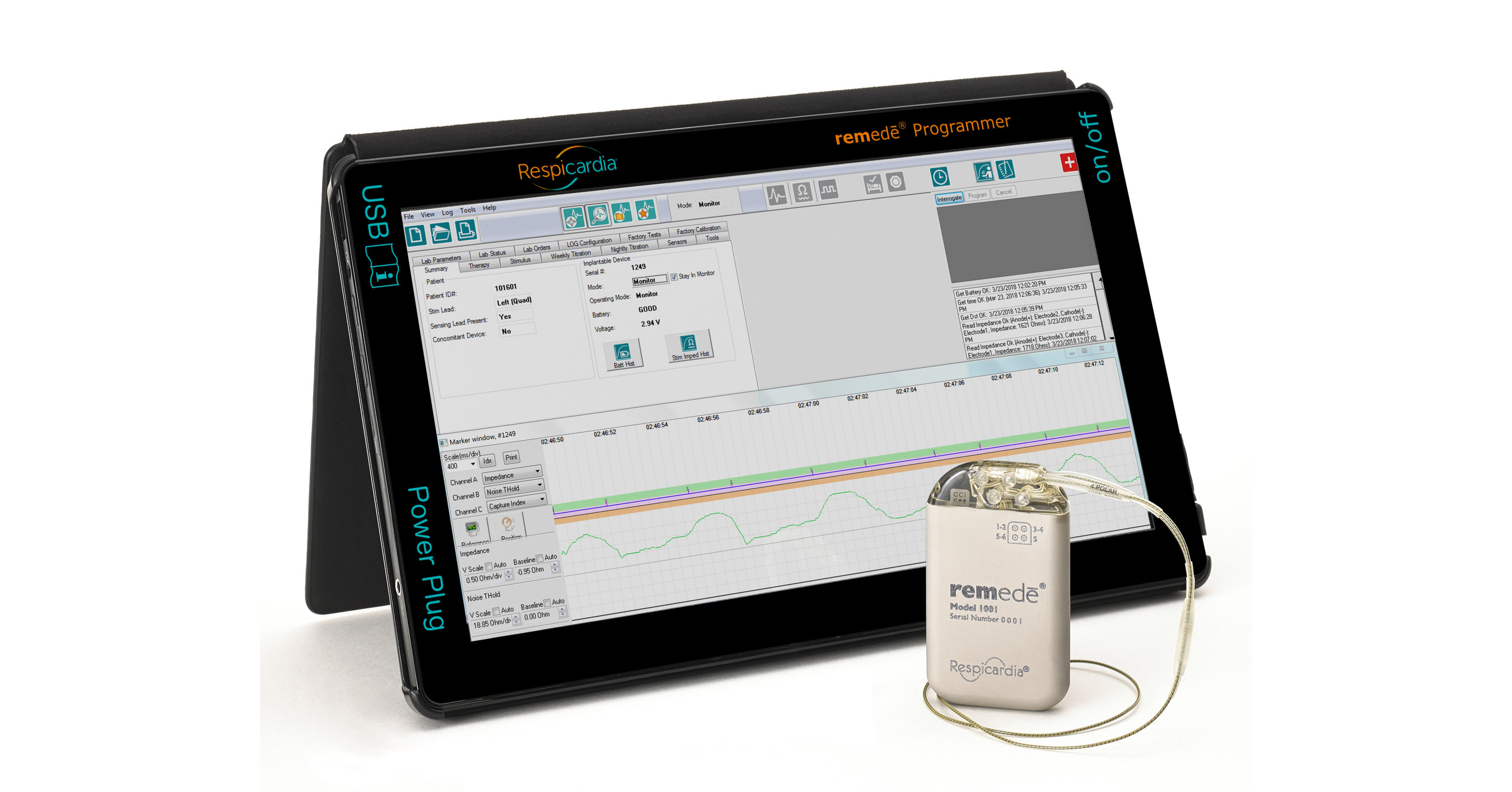 Transvenous phrenic nerve stimulation (The remedē System) shows ...