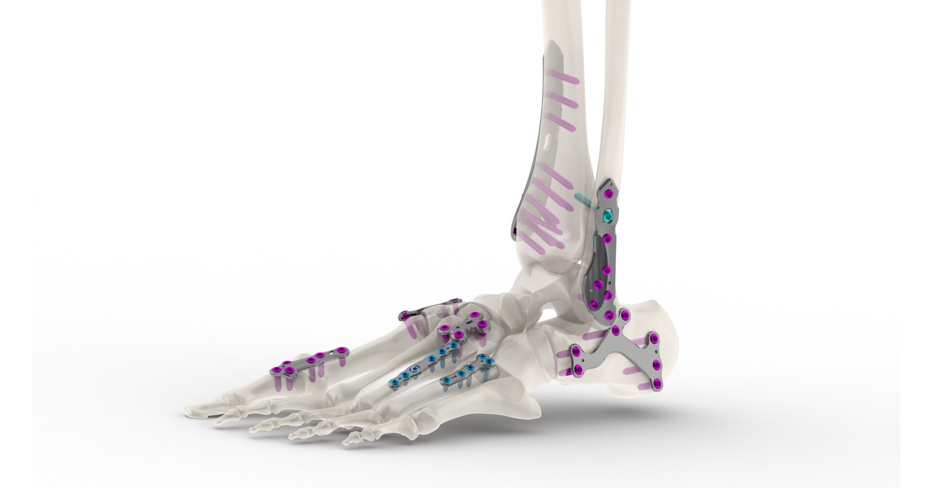 Tyber Medical Receives FDA Clearance on Foot and Ankle Plating Systems