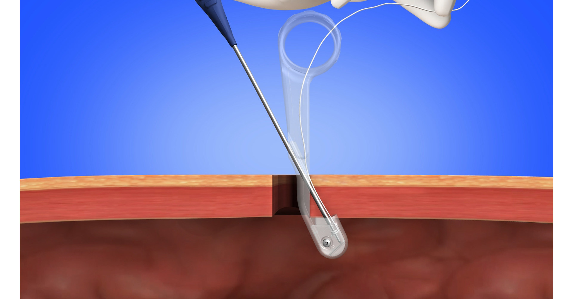 Sharp Fluidics® launches NeoClose® AnchorGuard: designed to safely ...