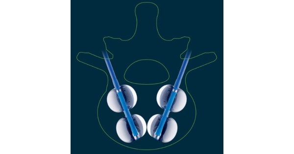 Stop'n GO Double Balloon Catheter (Quattroplasty®) Provides a New ...