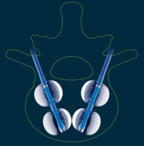 Stop'n GO Double Balloon Catheter (Quattroplasty®) Provides a New ...