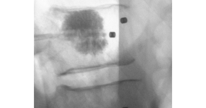 icotec ag Receives FDA Clearance for the VADER® Pedicle - System with ...