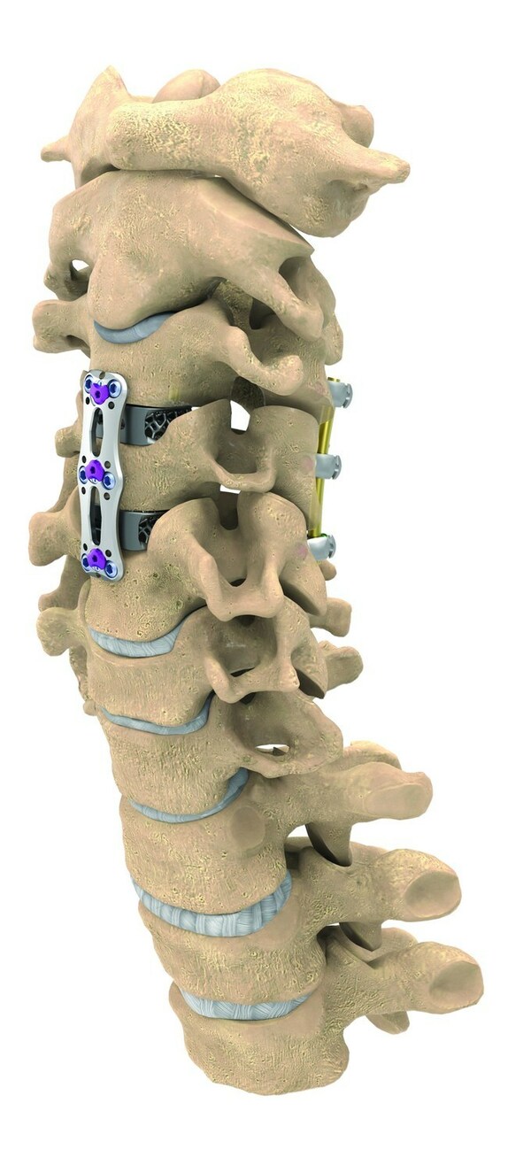 NuVasive Unveils C360 Portfolio and Launches New Anterior Cervical Plate
