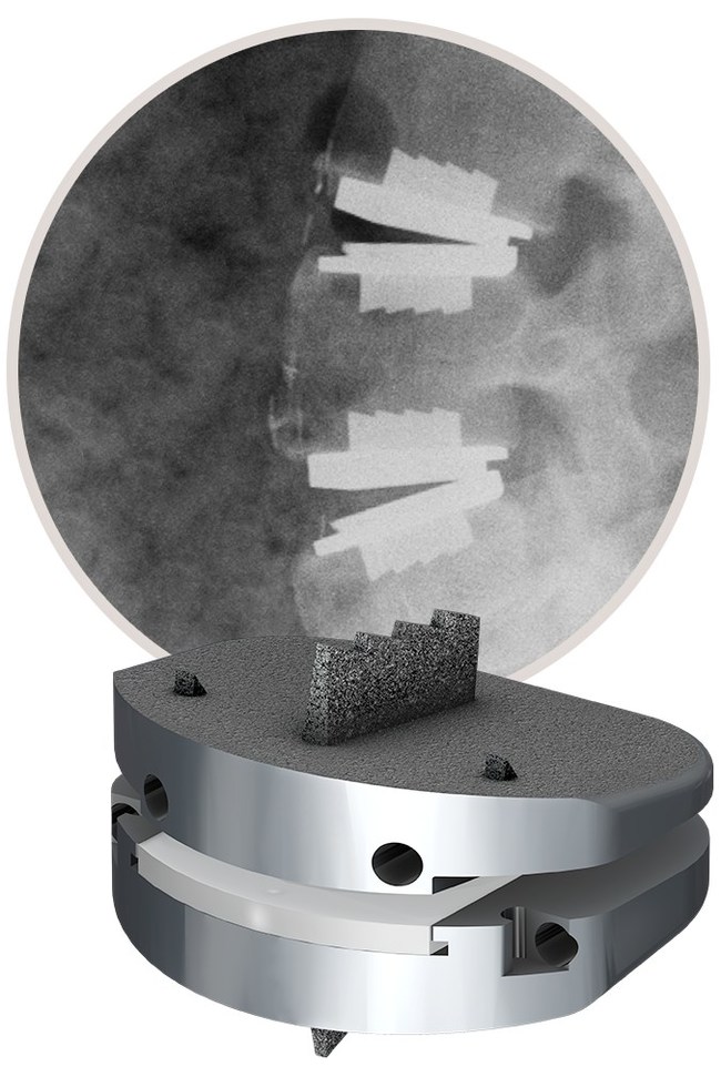 Centinel Spine Continues to Innovate in Total Disc Replacement through ...