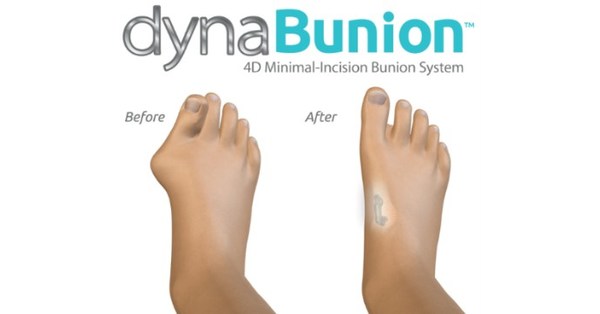 CrossRoads® Extremity Systems, LLC Announces Launch Of The DynaBunion ...