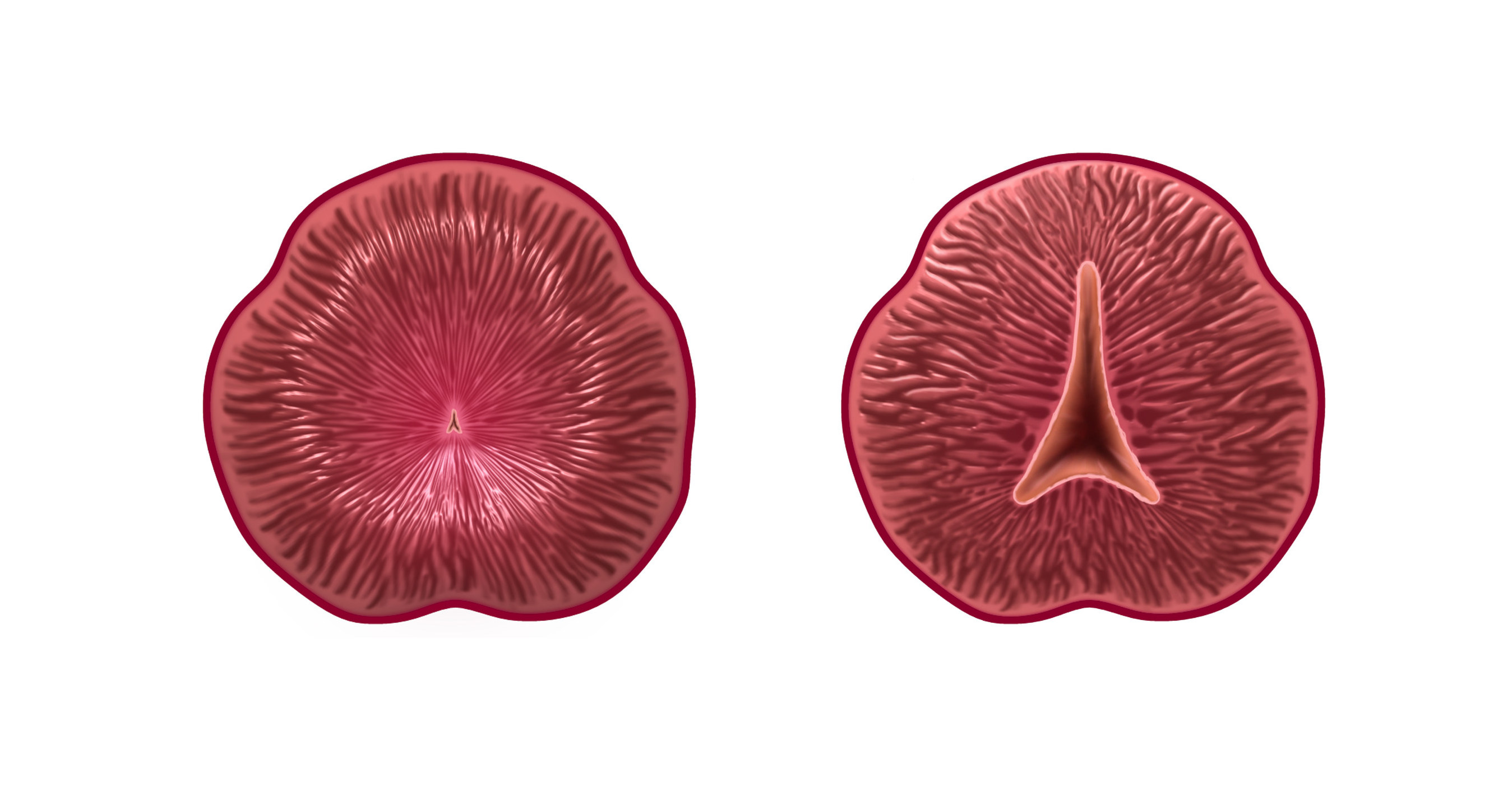 Olympus iTind Temporary Implant Rapidly Relieves Enlarged Prostate ...