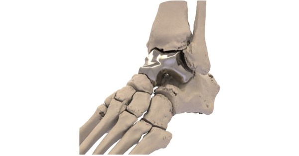 Additive Orthopaedics® Announces FDA Approval of Patient Specific Talus ...