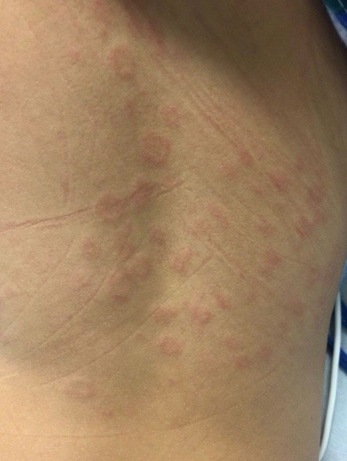Experts at Children's Hospital of Philadelphia Describe Types of Rashes ...
