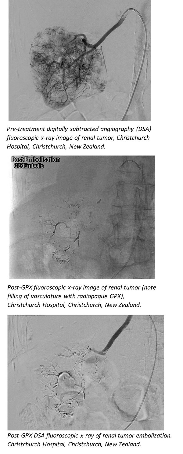New Embolic Device Blocks Vessels Feeding Malignant Tumors