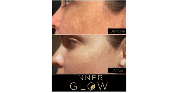 Finally, Sun Protection in a Pill - 'Inner Glow Vitamins' Introduces ...