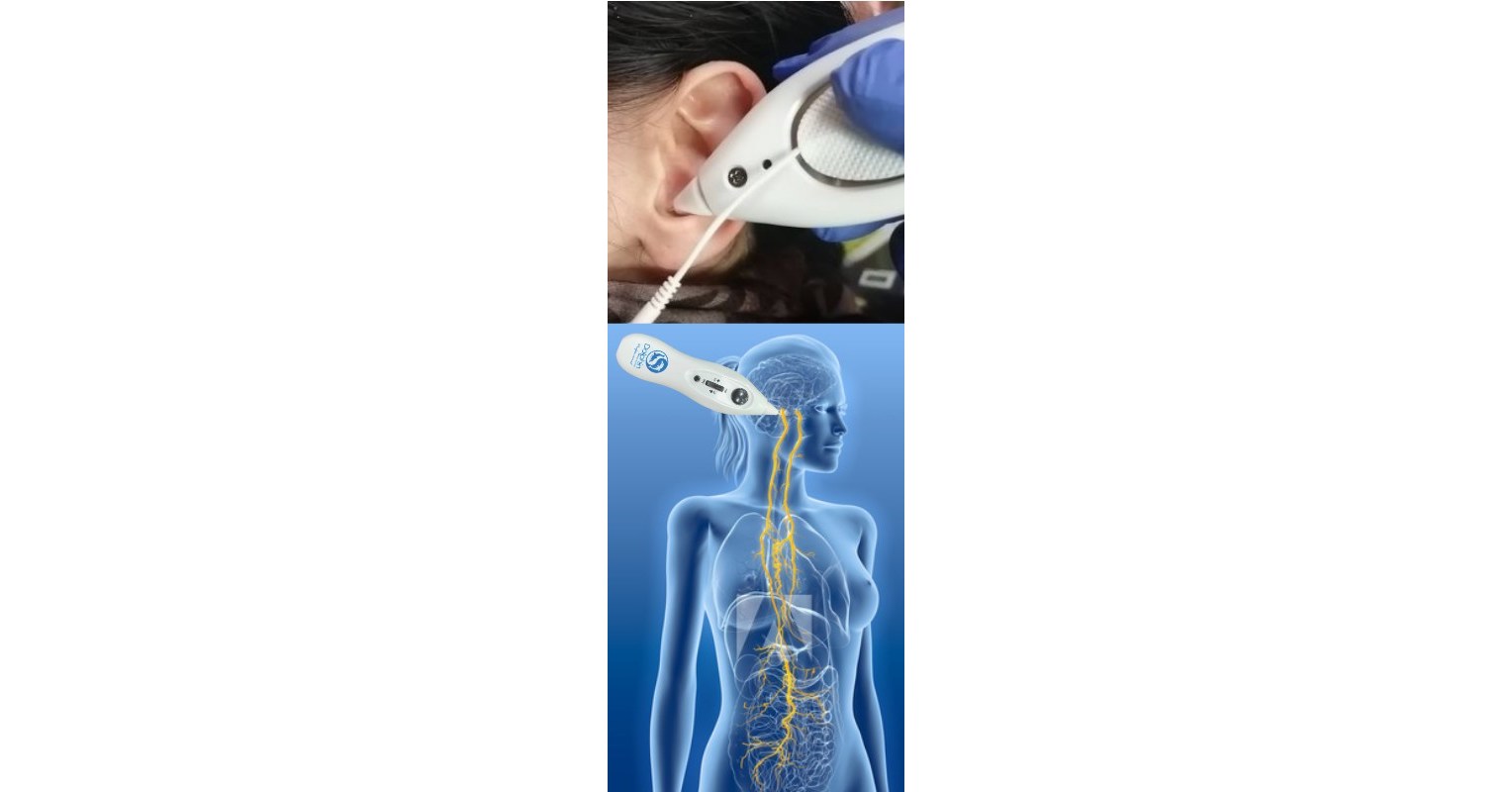 Health Canada now authorizes Dolphin Vagal Nerve Stimulator (VNS) for ...