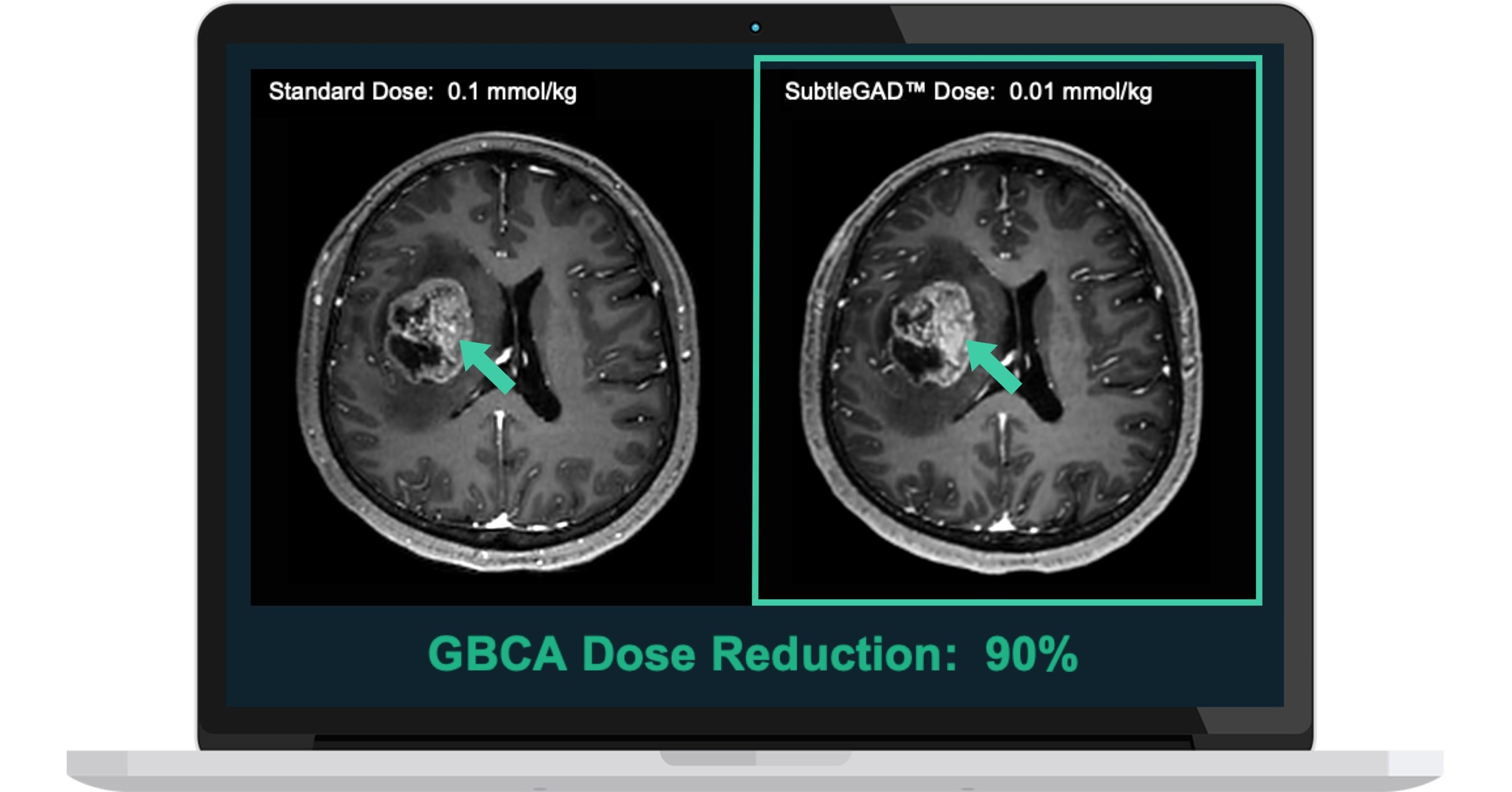 Subtle Medical Awarded Breakthrough Patent for Reduced Contrast Agent ...