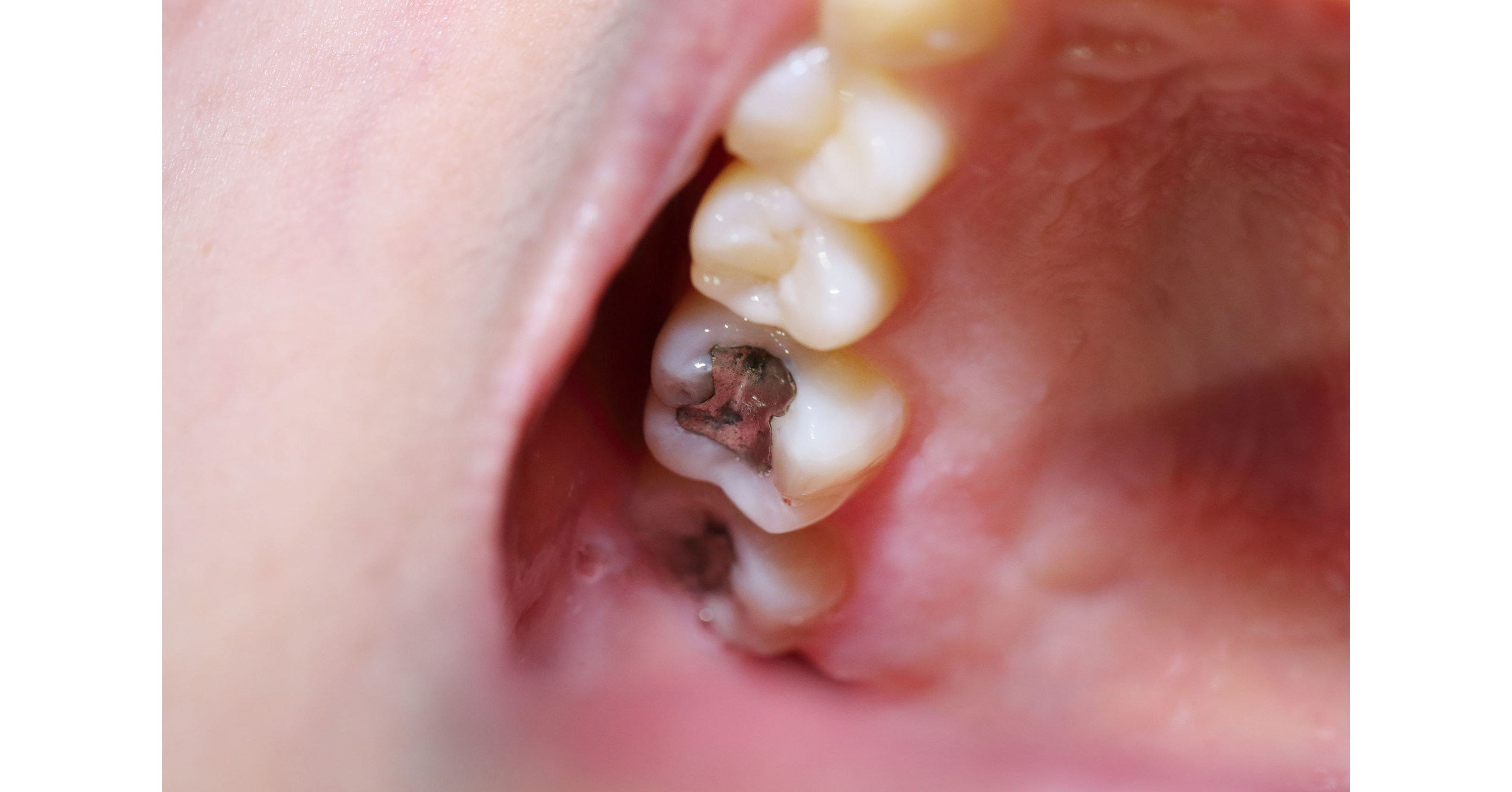 New Research Links Dental Amalgam Mercury Fillings To Arthritis