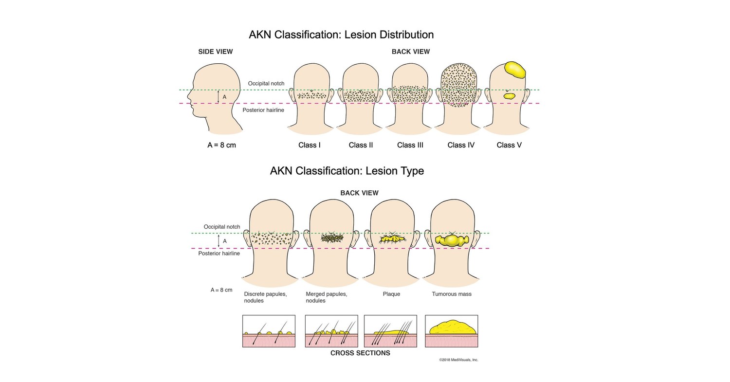A New Classification System Developed to Improve Treatment for Acne ...