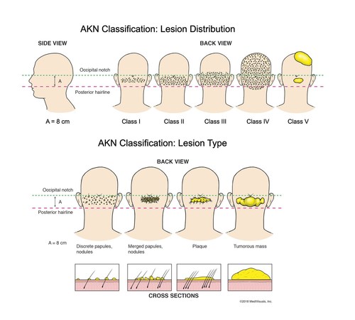A New Classification System Developed to Improve Treatment for Acne ...