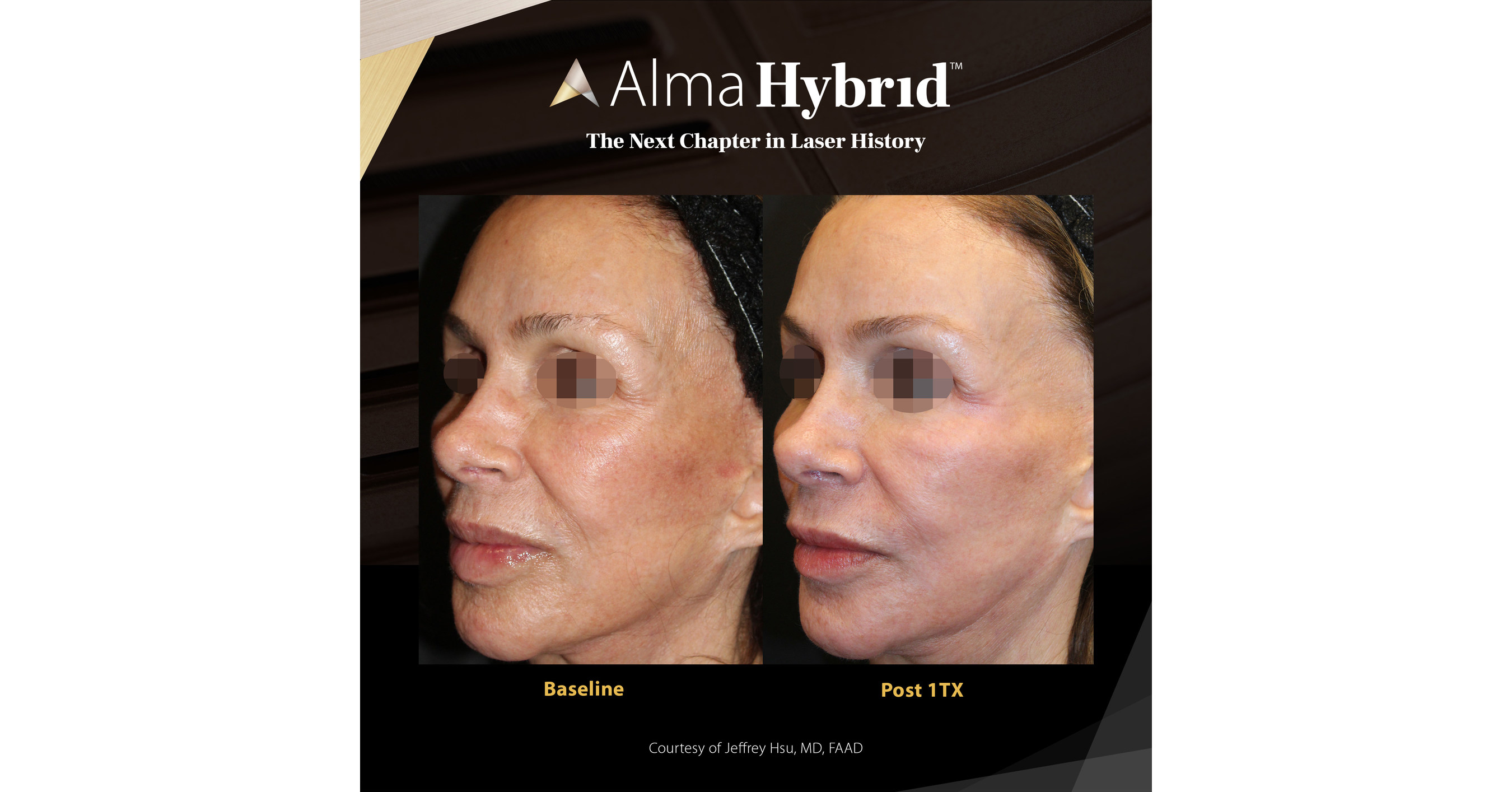 Alma, a Sisram Medical Company, Announces FDA Clearance and the U.S ...