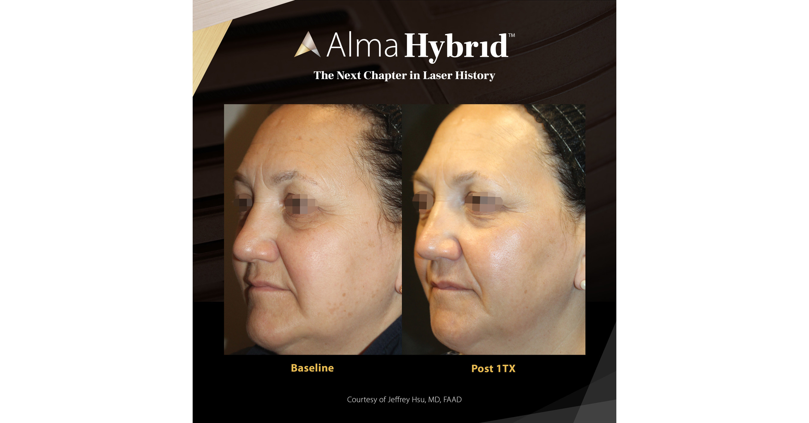 Alma, a Sisram Medical Company, Announces FDA Clearance and the U.S ...