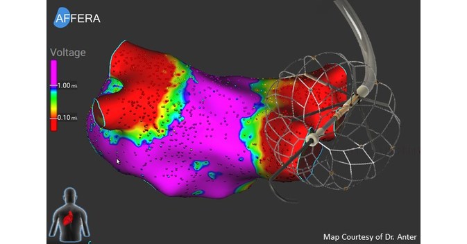 Affera, Inc. Announces Successful First-In-Human Use Of SpherePVI ...