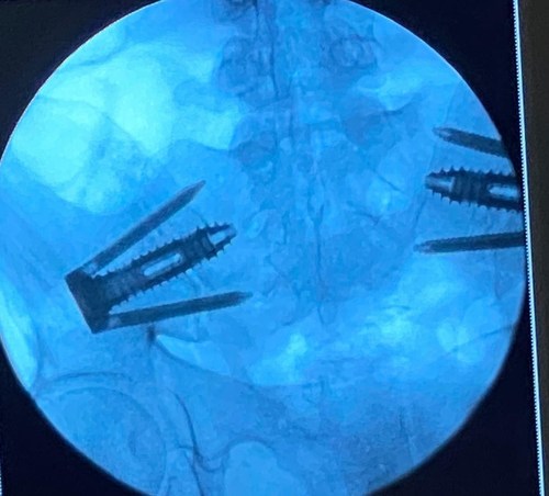 Inspired Spine has released a study of Perioperative Outcomes of ...